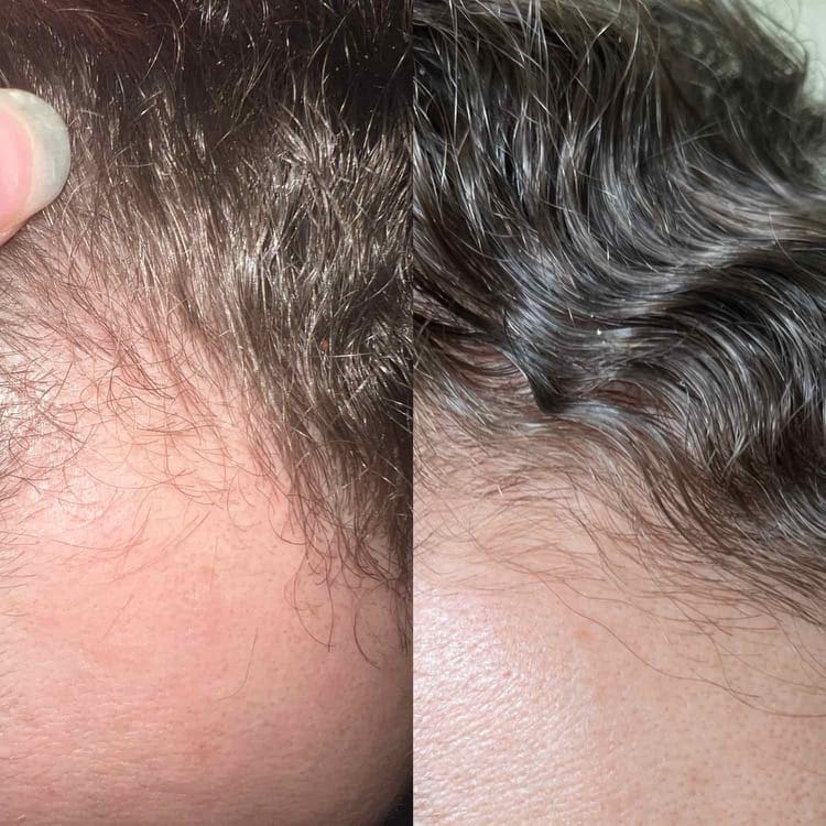 Micro Needling For Hair Loss | VC Dermal